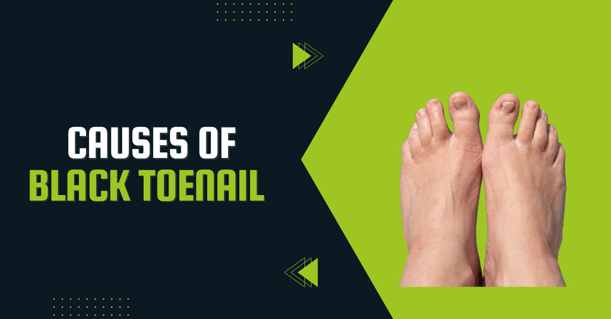 8 Causes Of A Black Toenail - Sustainable Food Trade Association ...